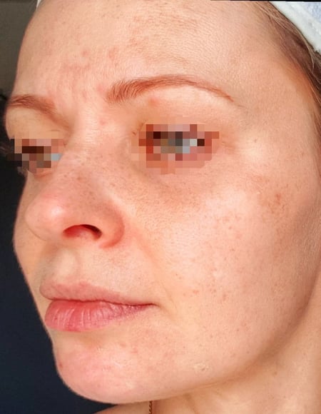 Cosmelan depigmentation peel: Real patient diaries