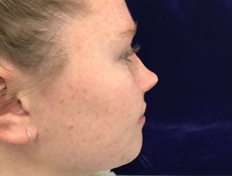 Benefits of LED light therapy for wound healing