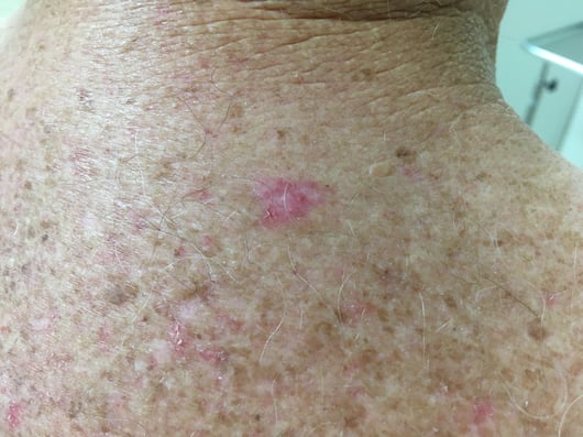 What you need to know about non-melanoma skin cancers