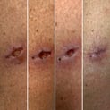 Benefits of LED light therapy for wound healing