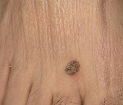 What can skin cancer look like?