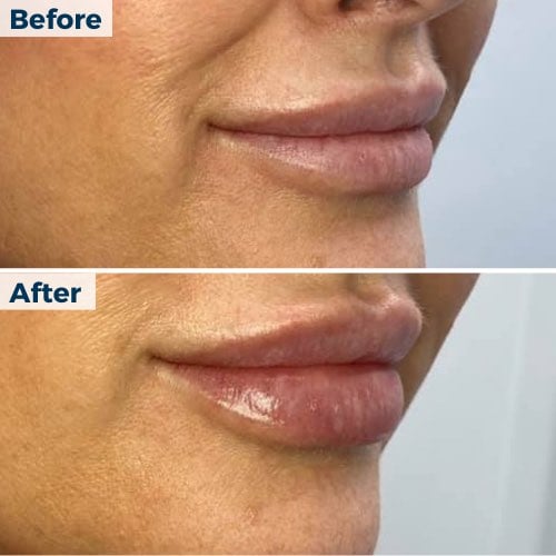 Lip enhancement (and how to avoid 'duck lips')