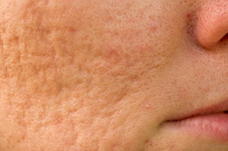 Steroid treatments | National Skin Cancer Centres