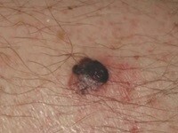 Nodular melanoma: What you need to know