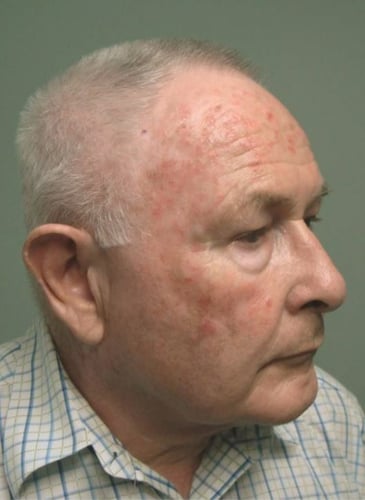 Sun damage repair | Skin Clinic, Australia