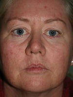 Sun damage repair | Skin Clinic, Australia