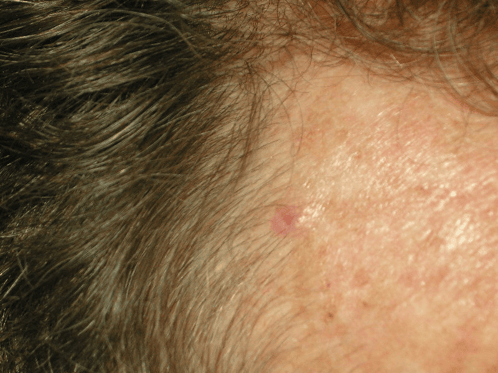 Squamous cell carcinoma: An overview