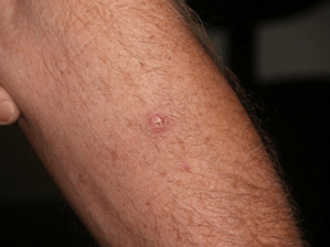 Squamous cell carcinoma: An overview