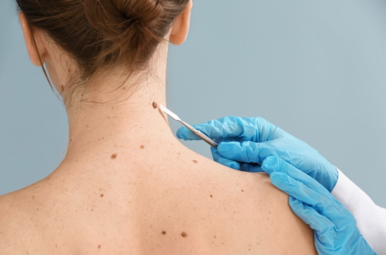Mole removal | Skin Clinic, Australia
