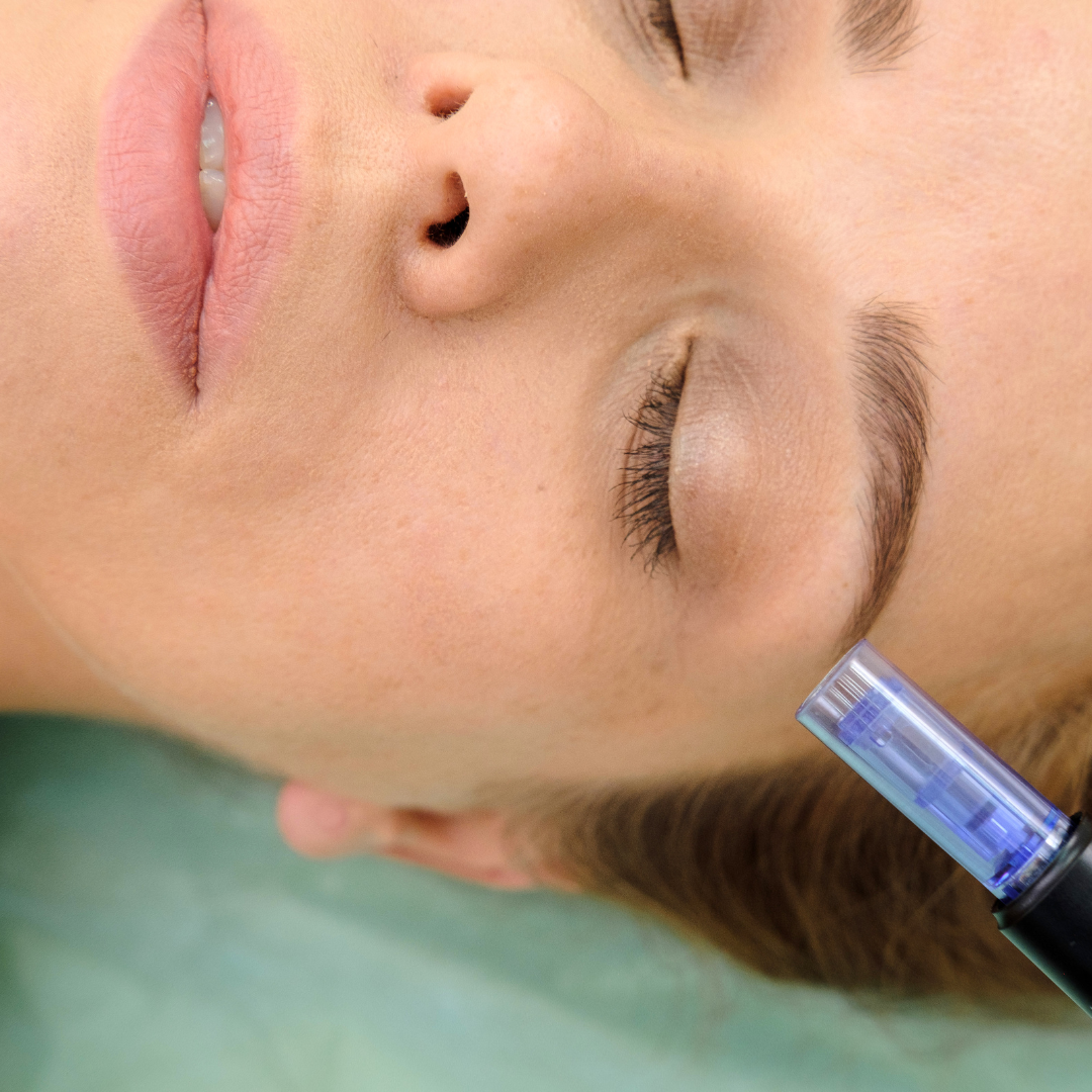 The Benefits of Nano-Needling