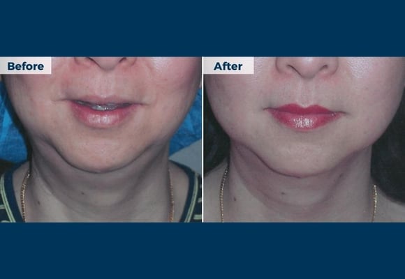Lip enhancement (and how to avoid 'duck lips')
