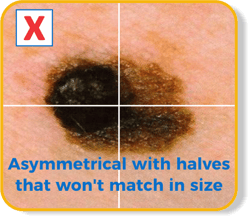 Your self-check skin cancer guide