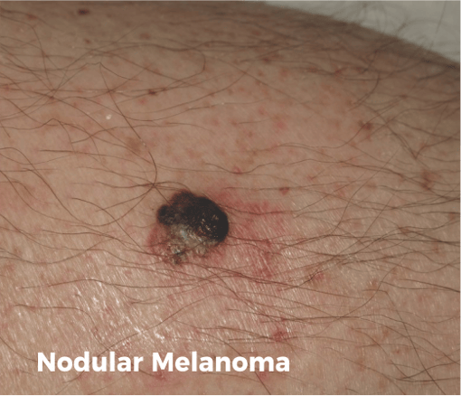 What are the different types of skin cancer?
