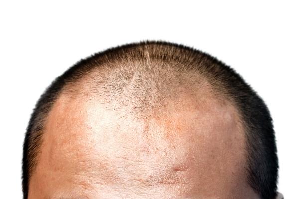 Do bald people have higher skin cancer risk?