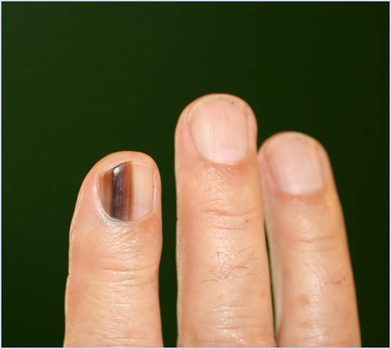 Acral melanoma: Everything you need to know