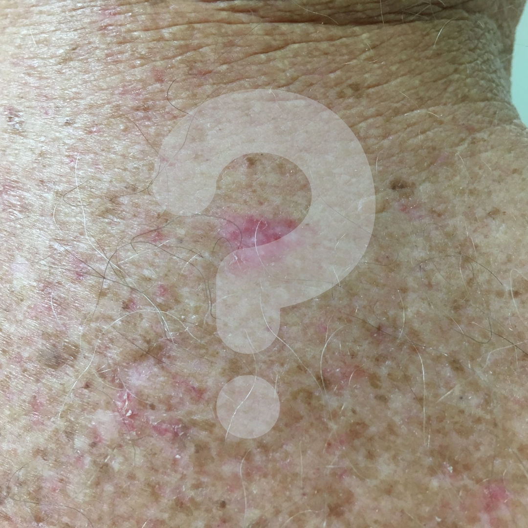 Basal cell carcinoma: An overview