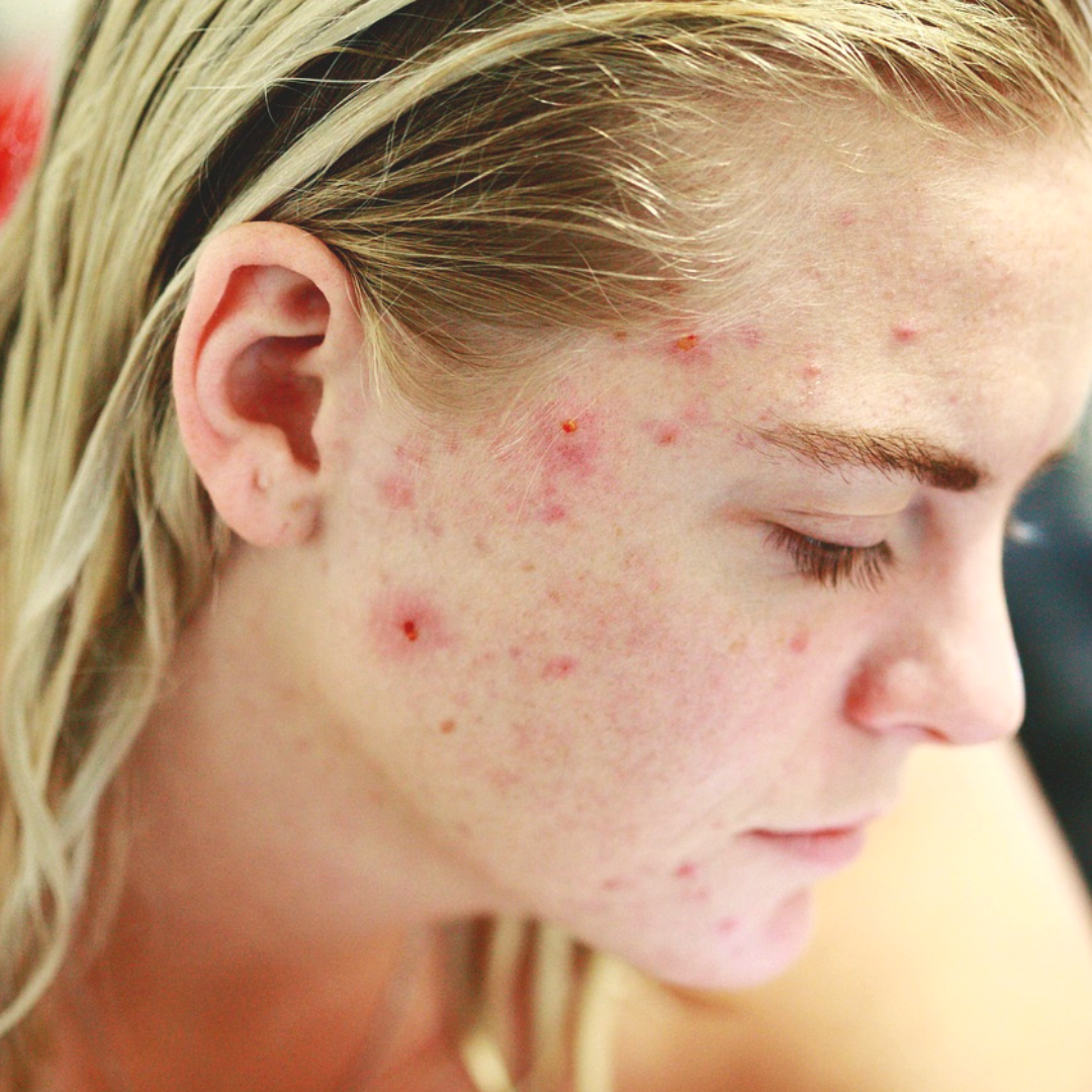 Managing acne: The 3 factors you need to understand