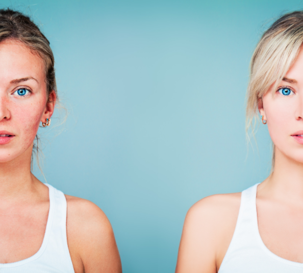 Ruddiness, rosacea and redness - oh my!