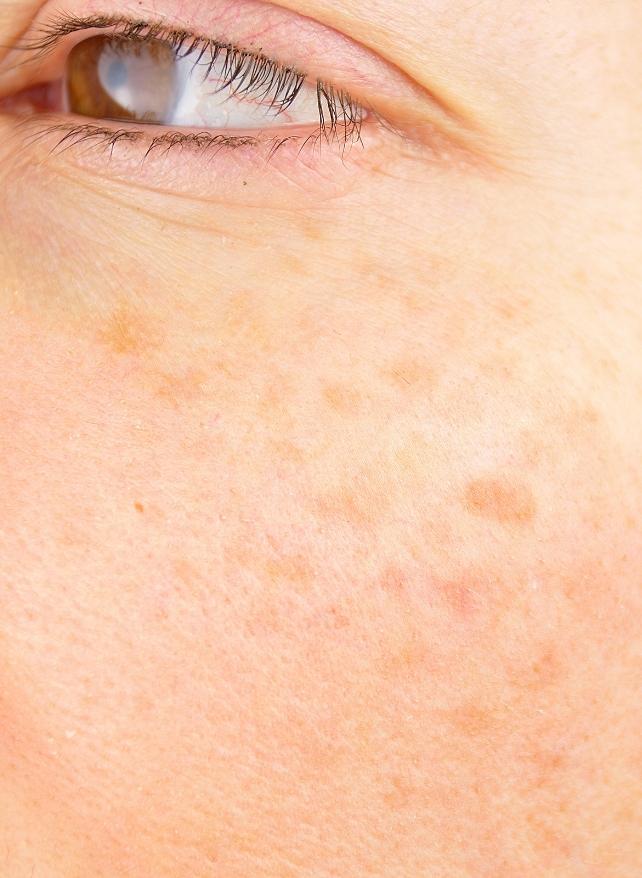 How can I repair my sun-damaged skin?