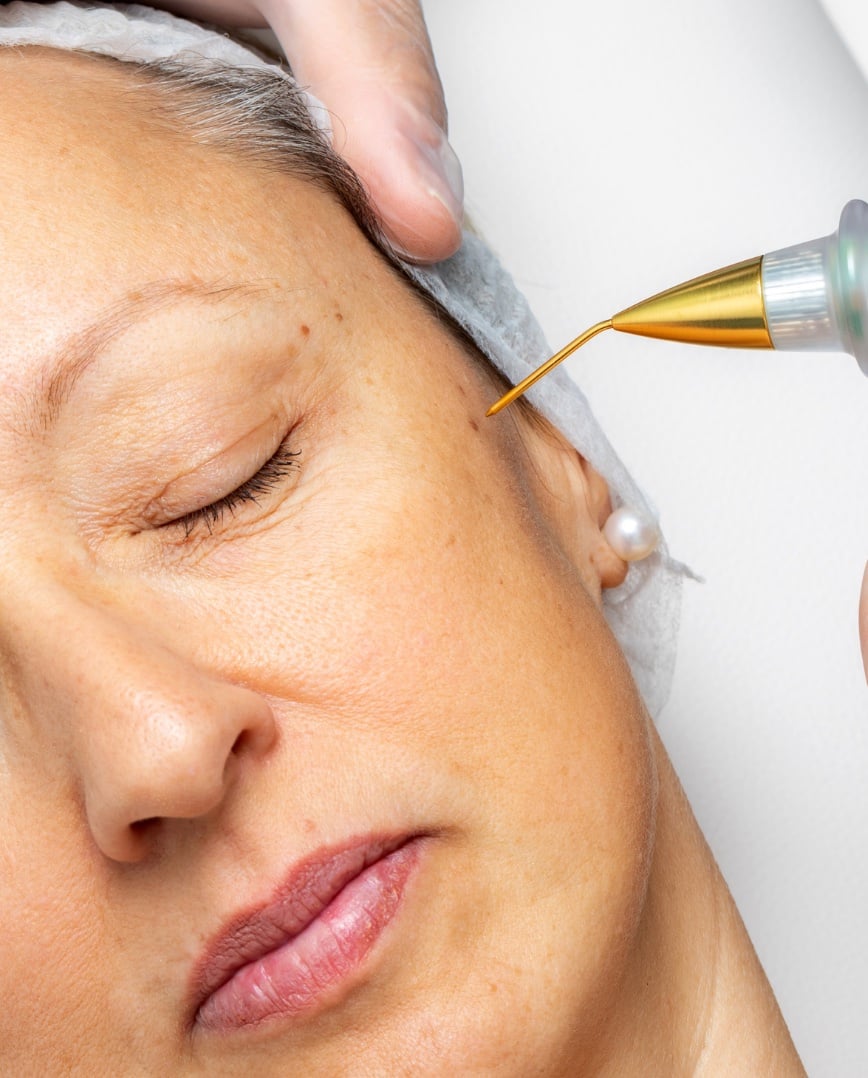 Fibroblast Plasma Skin Tightening | National Skin Cancer Centres