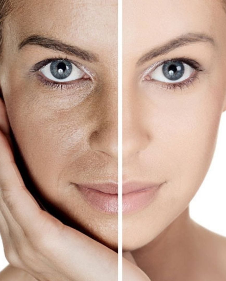 Top 4 treatments for pigmentation and melasma