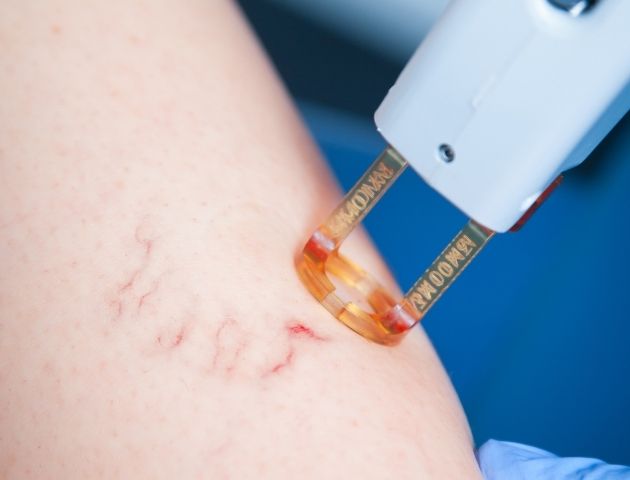 Laser vascular treatments and its benefits | Skin Clinic, Australia