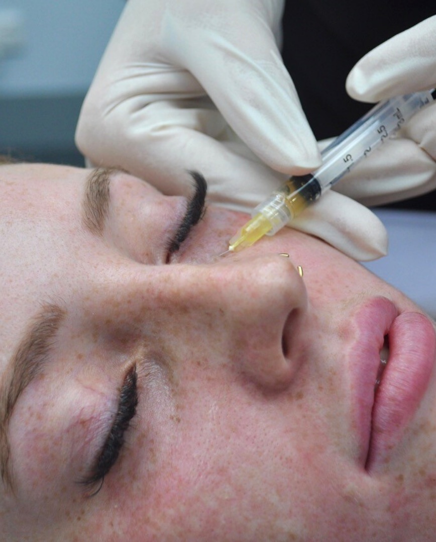 Autologous Liquid Gold Facelift | National Skin Cancer Centres